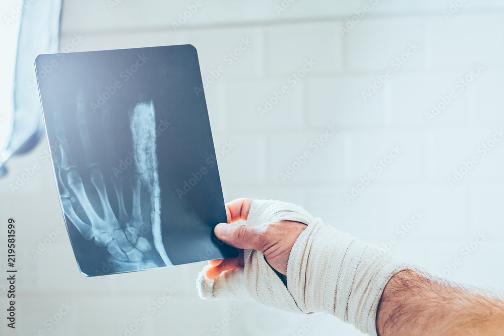 X-ray picture of a fracture of the hand to the lumen in the damaged ...