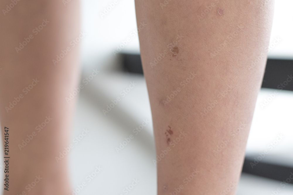 .Selective focus on dried skin legs of Asia kid child with lesions rash ...