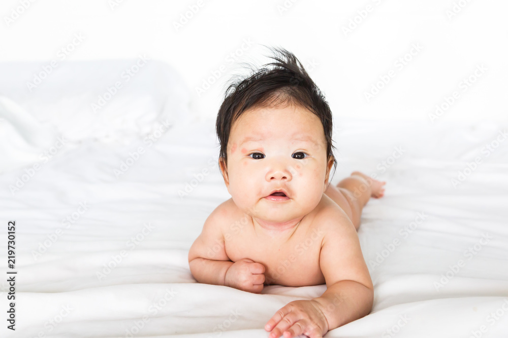 Asian Baby Girl With Red Spots On Skin Face Stock Photo Adobe Stock