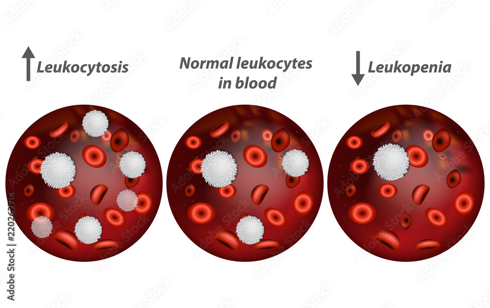 Leukocytosis and Leukopenia. White blood cell count. Stock Photo ...
