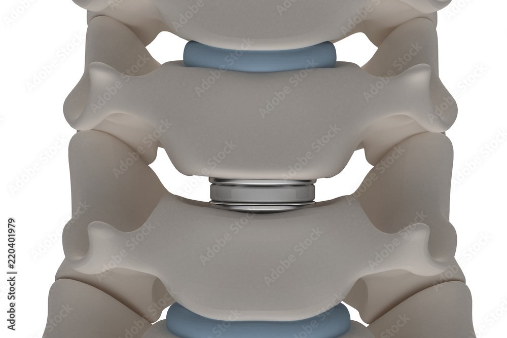 Artificial intervertebral disc prosthesis is installed between the ...