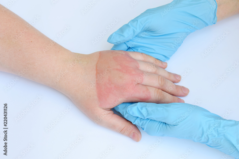Doctor's hands holding female hand with second degree burns on white ...