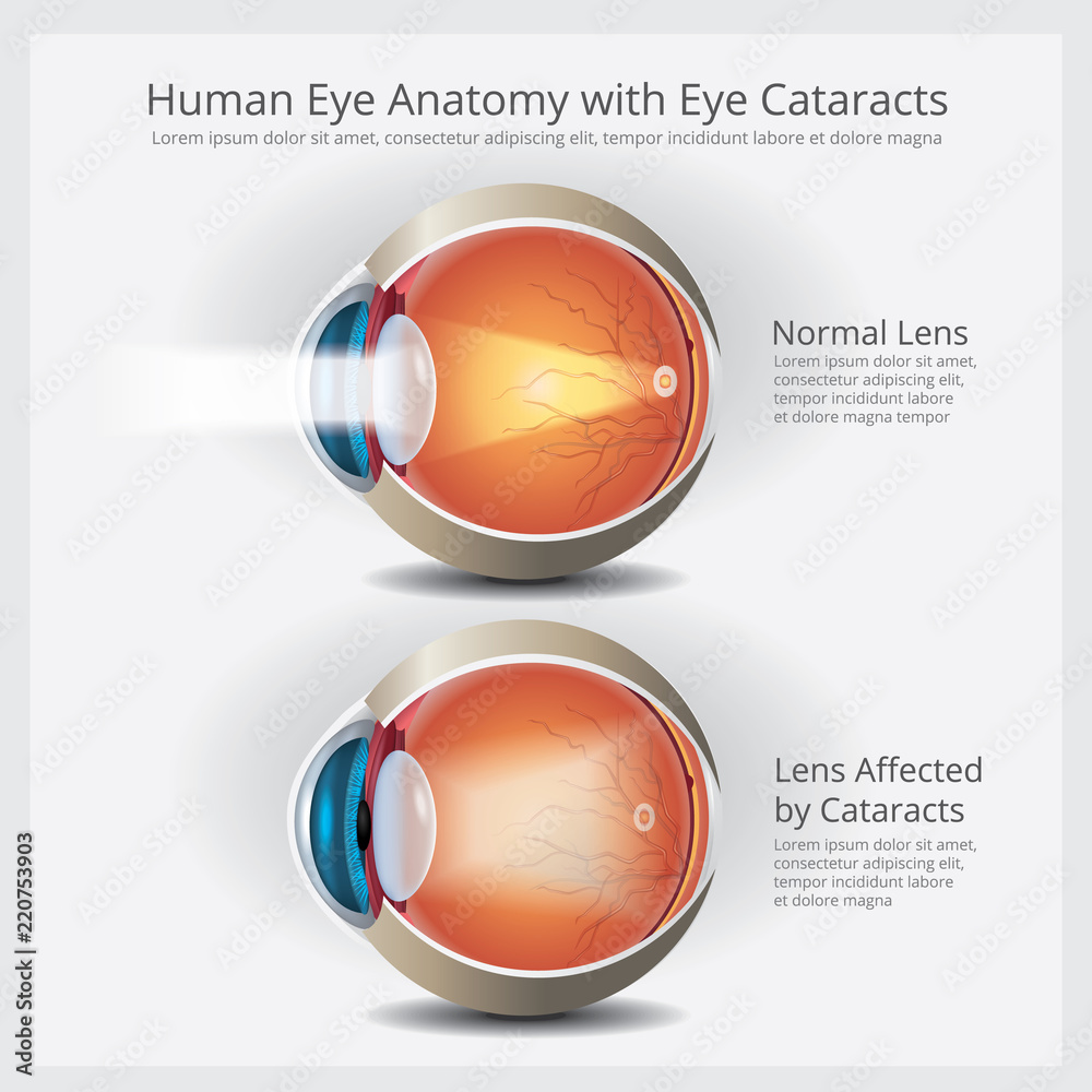 Human Eye Anatomy and Normal Lens Vector Illustration Stock Vector ...