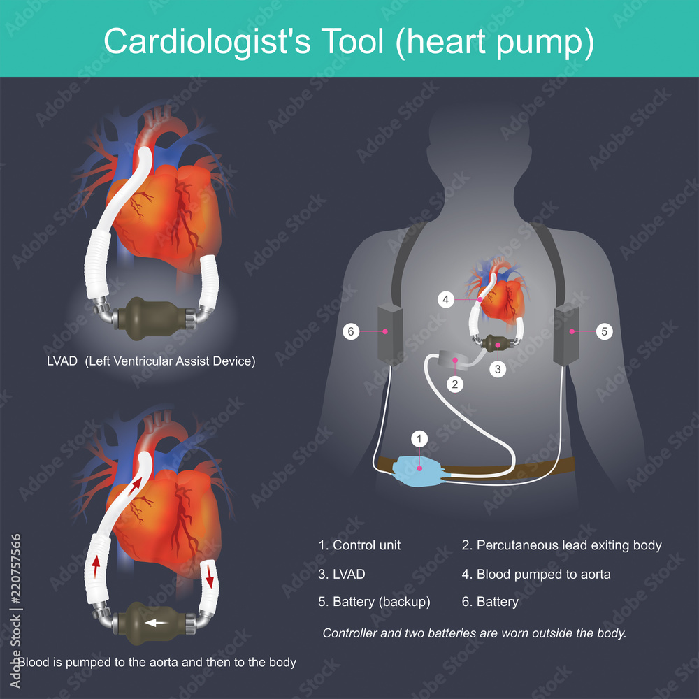 A Cardiologist's Tool (heart pump). This electronic device is used to ...