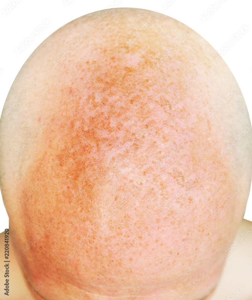 pigment spots on the head from sunburn Stock Photo | Adobe Stock