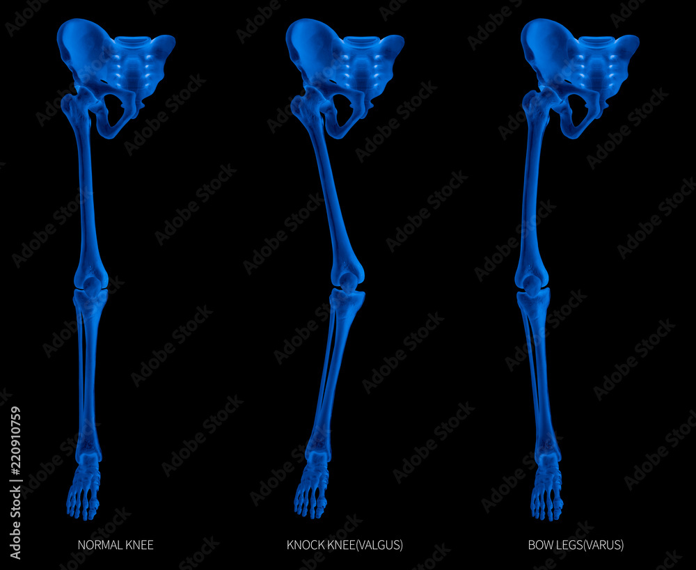 Types disease of lower half limbs or leg bone problem- normal-knock ...