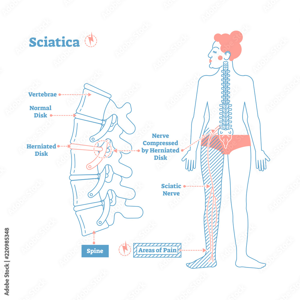 Sciatica medical health care vector illustration diagram scheme with ...