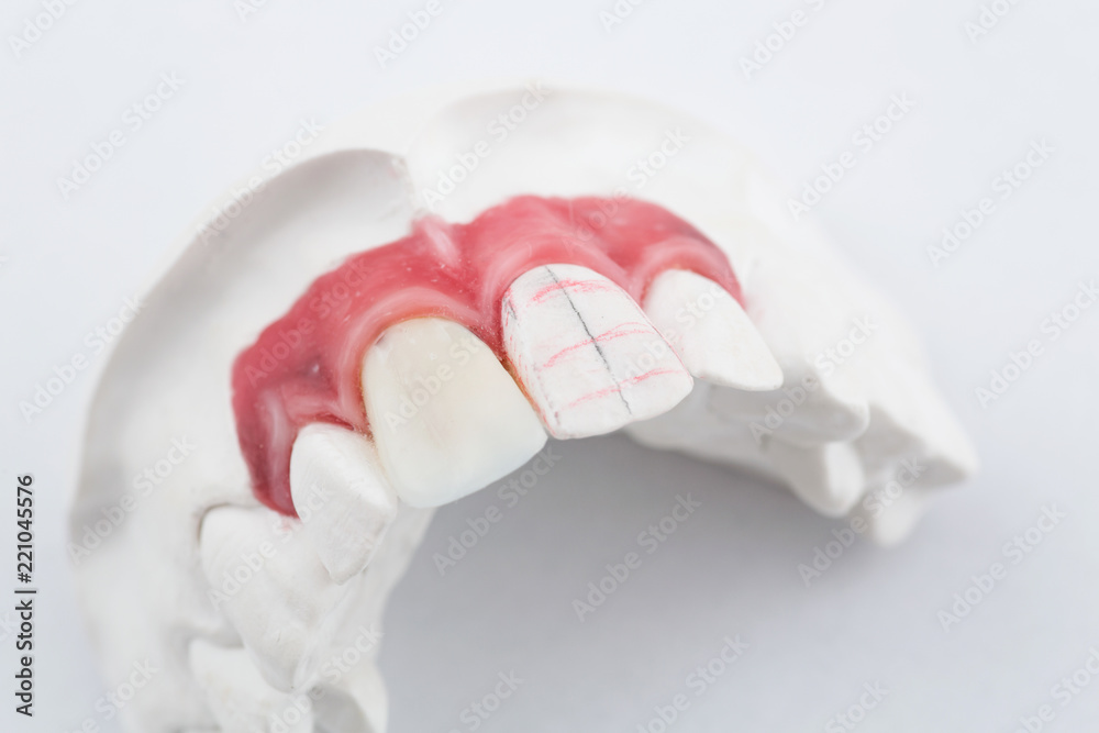 Wax pattern teeth dental crowns on model, metal free - front view ...