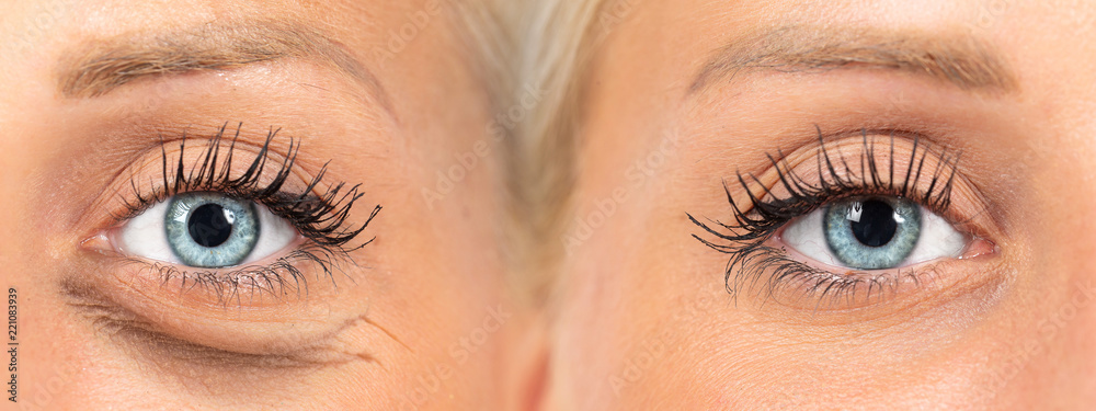 Saggy skin under eye before and after removal Stock Photo | Adobe Stock