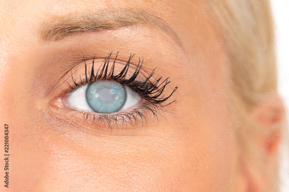 Female eye with corneal opacity and cataracts Stock Photo | Adobe Stock