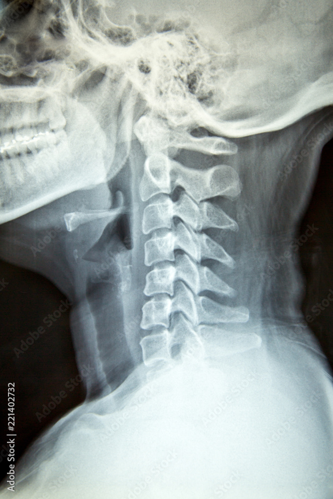 Close up x-ray film show cervical spine or c-spine, neck bones x-ray ...