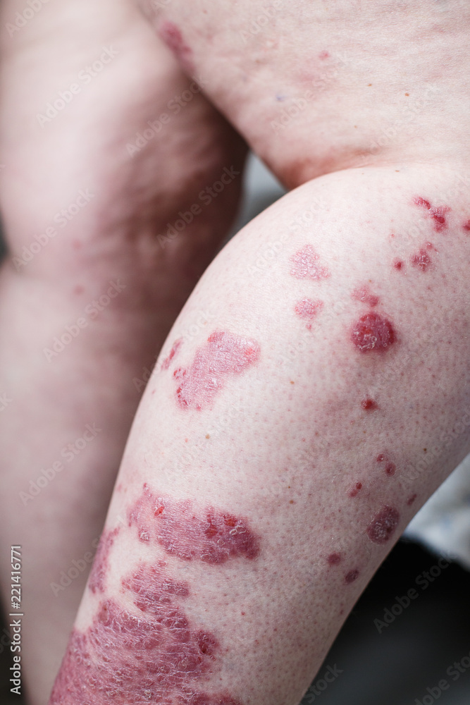 Close up ill allergic rash, eczema skin of patient , atopic dermatitis ...