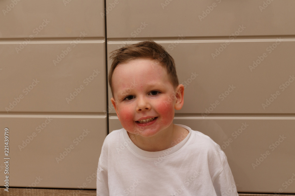 the boy has red cheeks, a rash on his cheeks in the child, a rash on ...