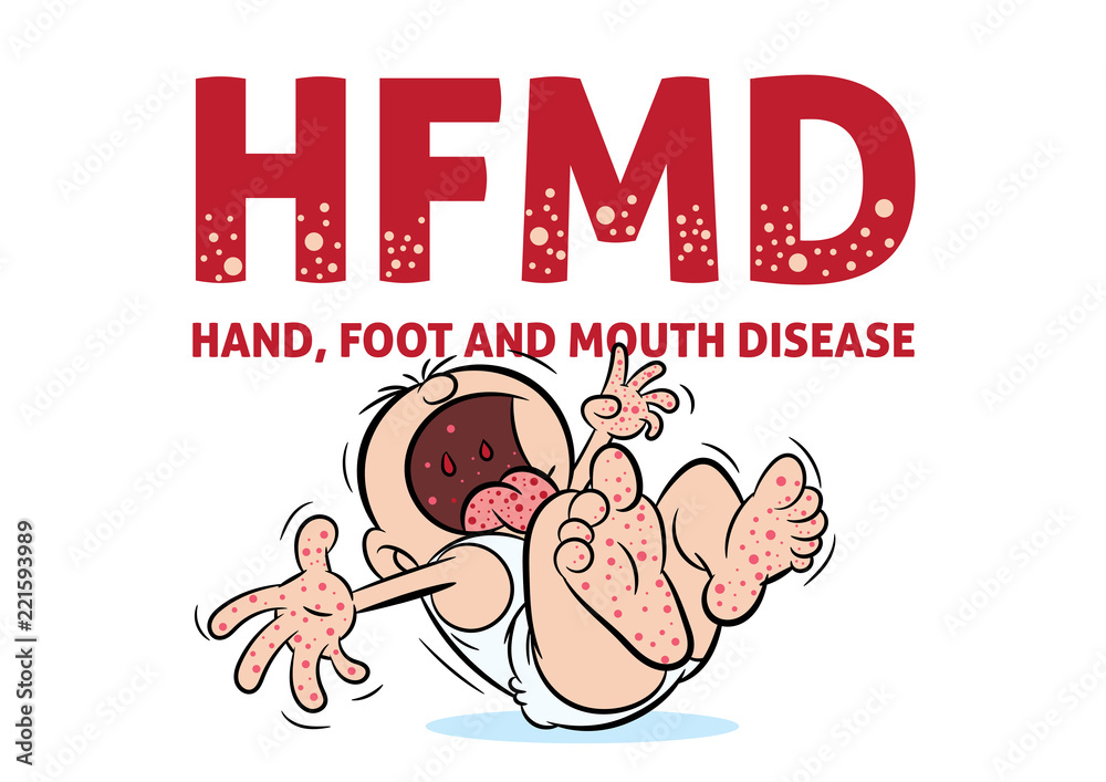 Crying baby with hand, foot and mouth disease or HFMD illustration ...