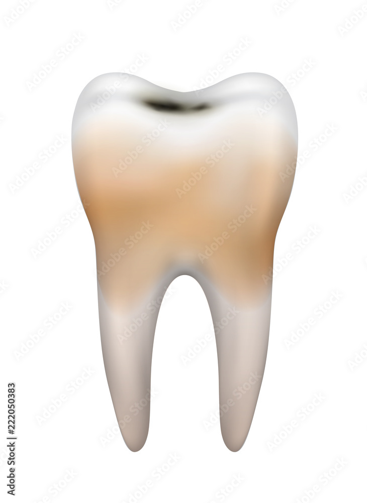 Vector realistic illustration of dirty unhealthy tooth with dental ...