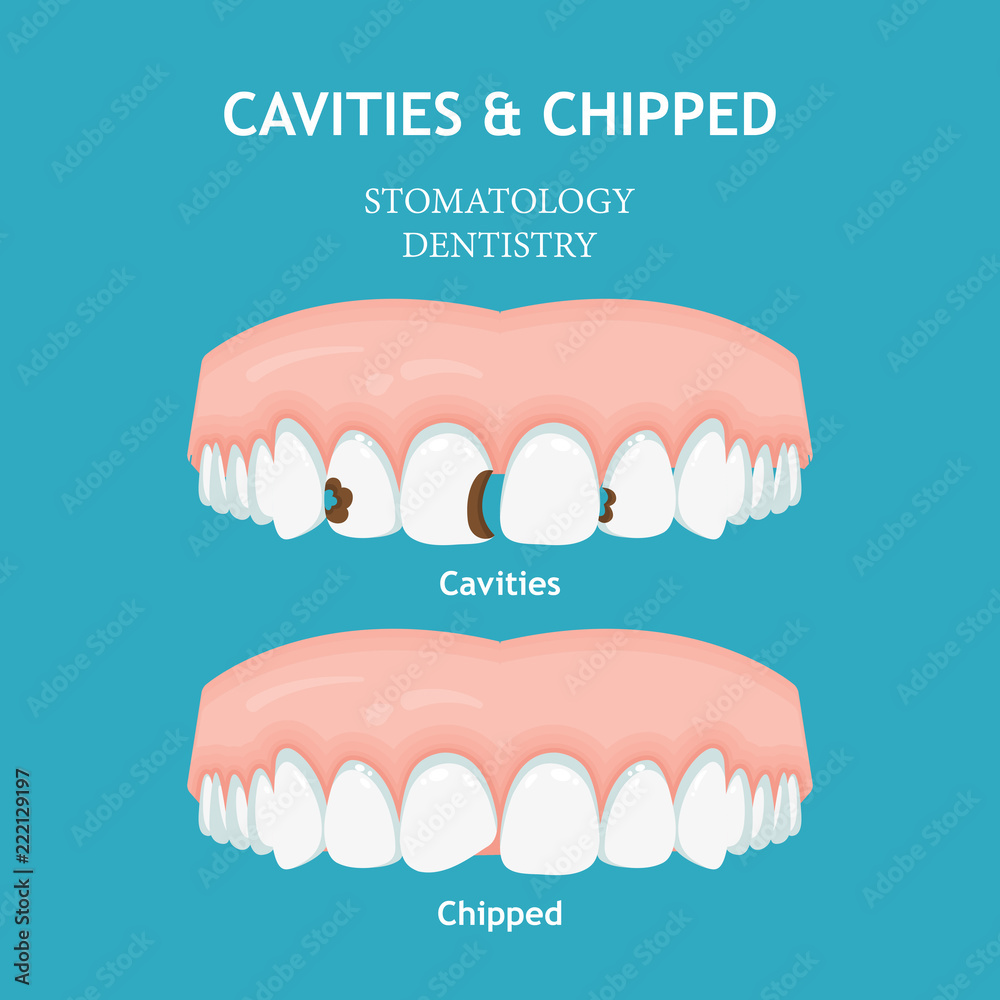 Dental concept. Dentistry and stomatology poster. Cavities and chipped ...