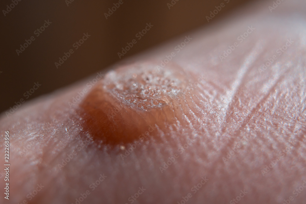 Foto de Verruca close up, warts removing concept do Stock | Adobe Stock