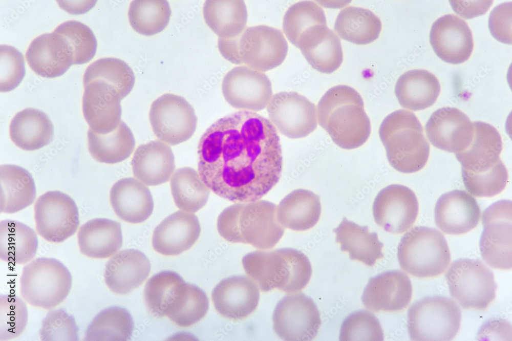 Neutrophil cell in blood smear, analyze by microscope Stock Photo ...