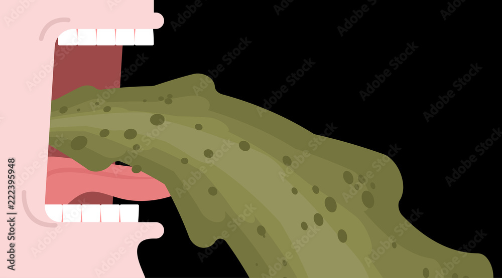 Vomit open mouth. Puke Vector illustration. Retching cartoon. Vomitus ...