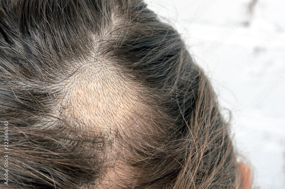 Mycosis of the scalp. Mycosis, stripping on my head. Lishay girl 9 ...