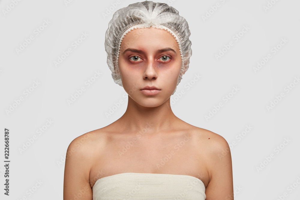 Woman patient wears medical hat, has bruises after skin resurfacing ...