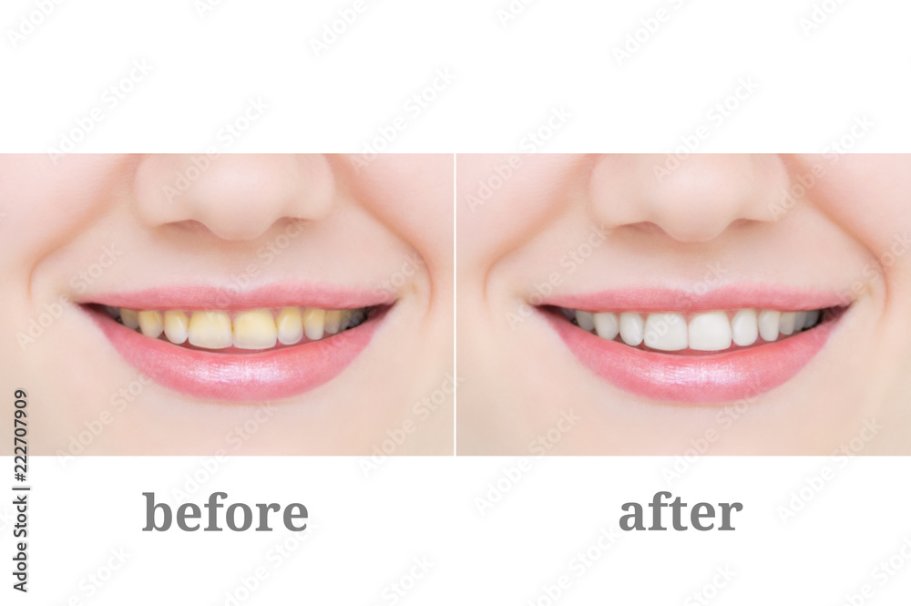 Teeth with yellow coating close-up after dental therapy and whitening ...