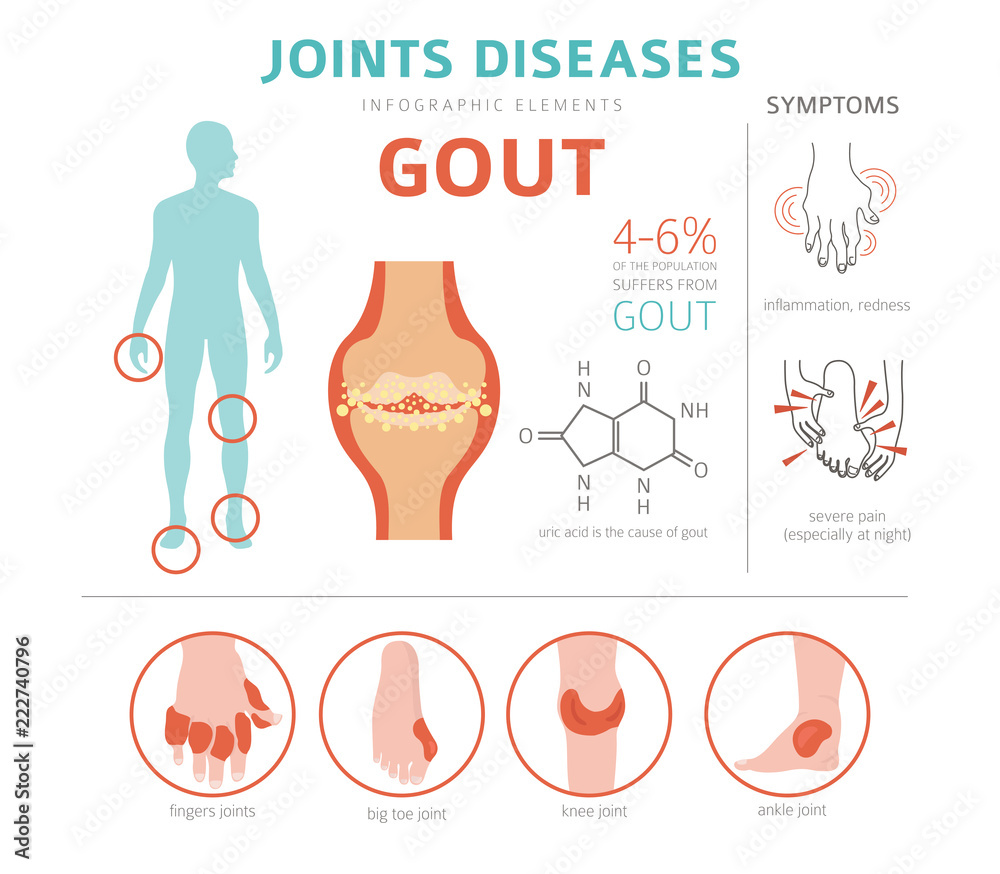 Joints diseases. Gout symptoms, treatment icon set. Medical infographic ...