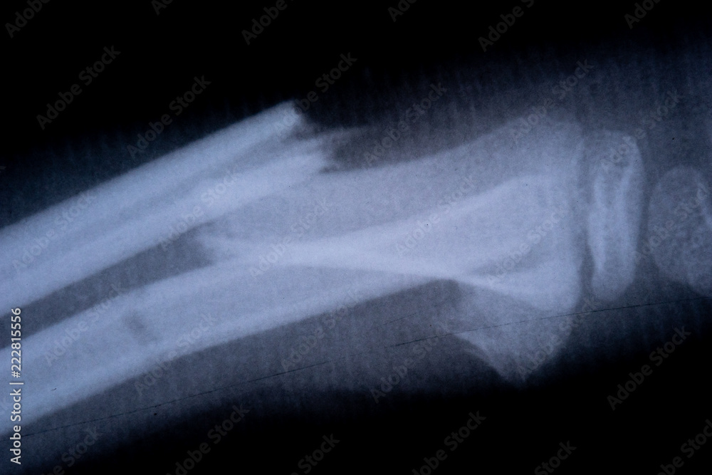 x-ray film skeleton human arm. health medical anatomy body concept ...