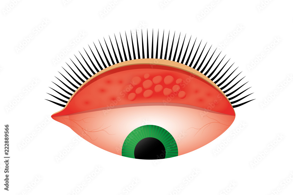 Trachoma vector illustration. Follicles on the upper eyelid Stock ...