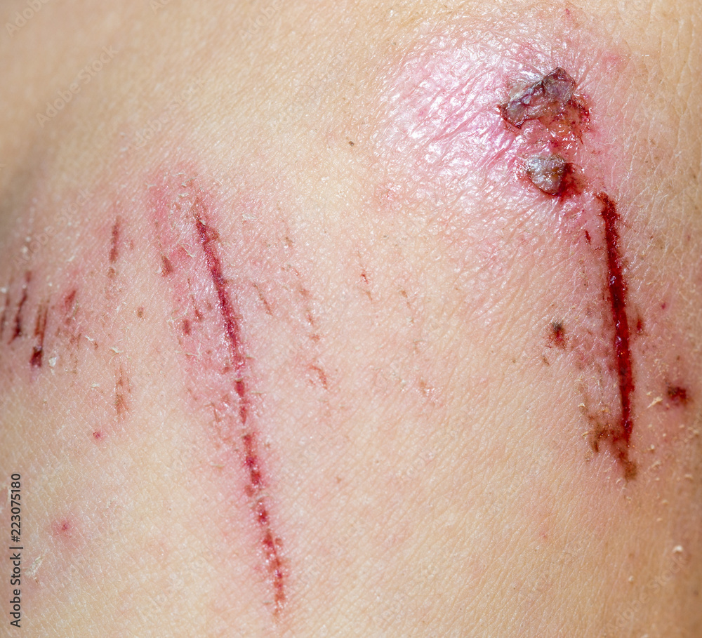 Wound on the skin of a macro Stock Photo | Adobe Stock