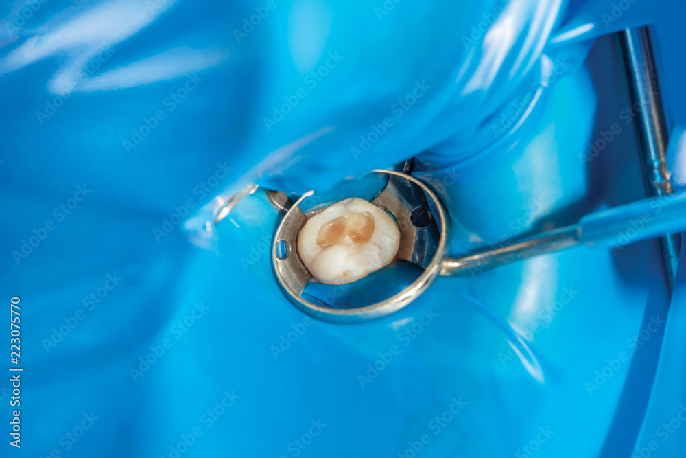 Restoration of the molar of a human tooth with filling material. The ...