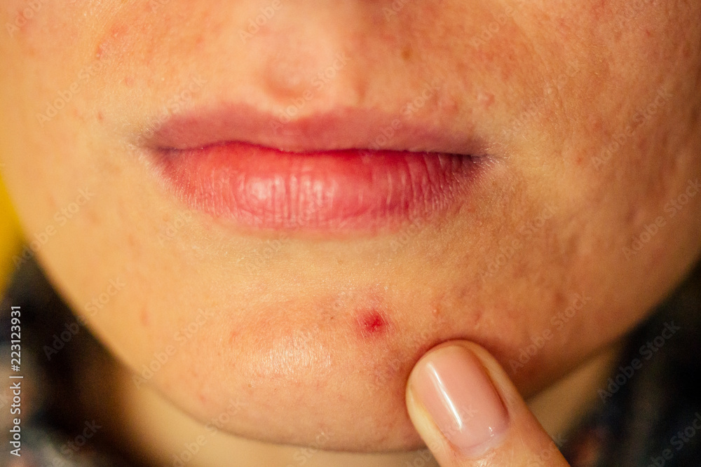 post-acne, scars and red festering pimples on the face of a young woman ...