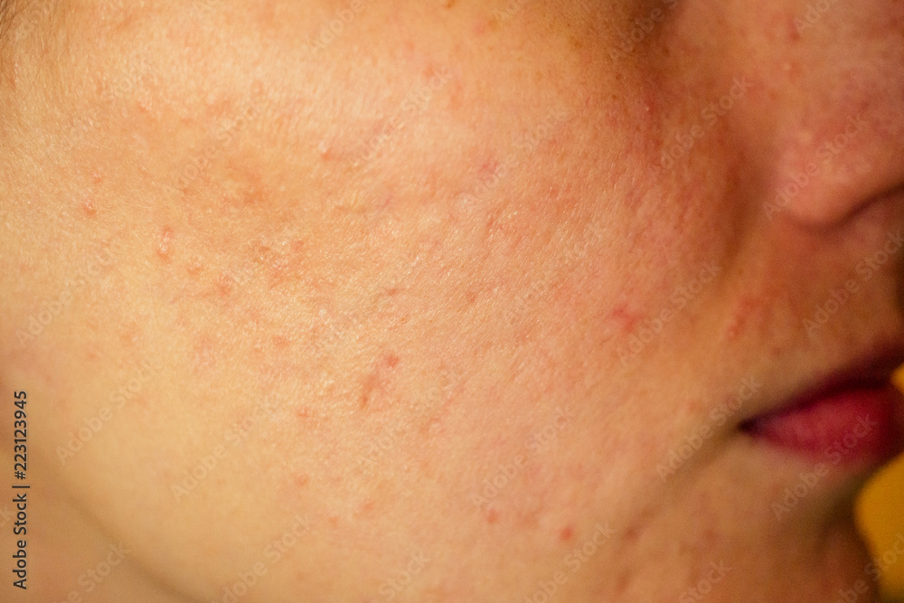 post-acne, scars and red festering pimples on the face of a young woman ...