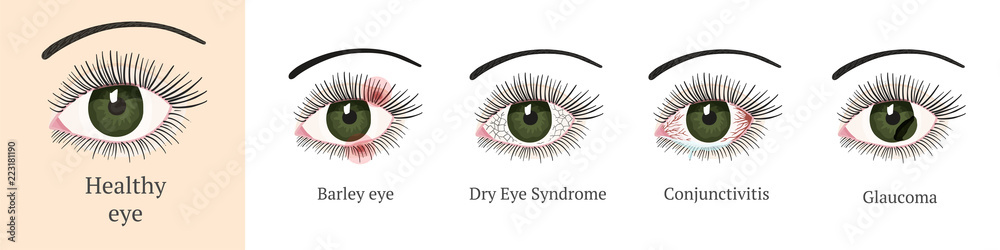Poster Most common eye problems – Wall Art | UkPosters
