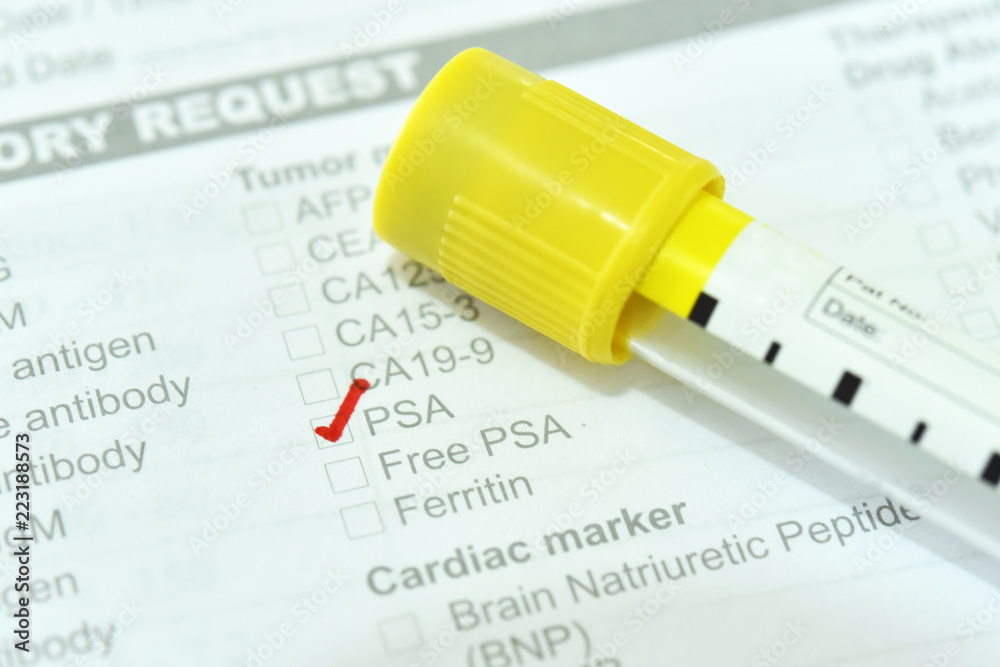 Blood sample tube with lab requisition form for PSA test, prostate ...