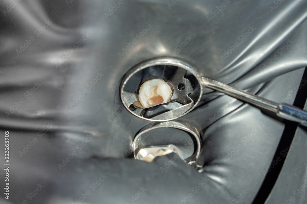 Restoration of the molar of a human tooth with filling material. The ...