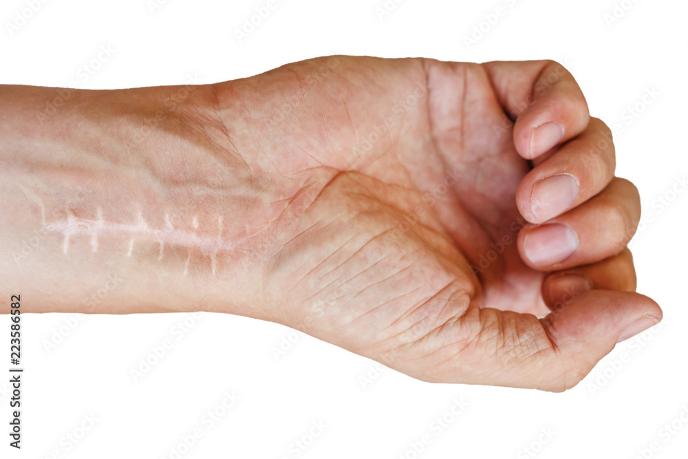 Scar with stitches on the wrist after surgery. Fracture of the bones of ...