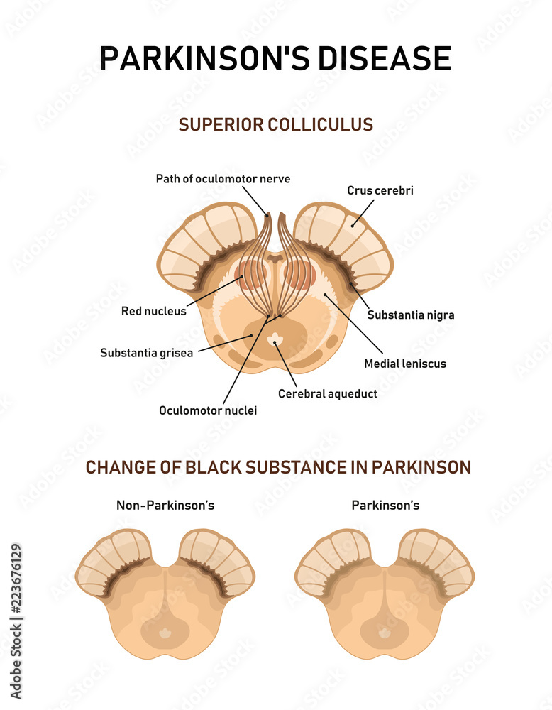 Photo Midbrain anatomy. Parkinson's disease, nmfotograf | Posters ...