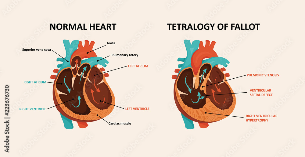 Congenital disease of the heart: Ventricular septal defect, Right ...