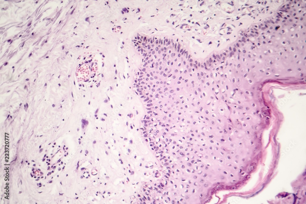 Basal cell carcinoma, skin cancer, light micrograph, photo under ...