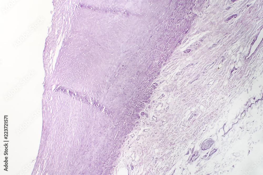 Aortic atherosclerosis, light micrograph, photo under microscope Stock ...