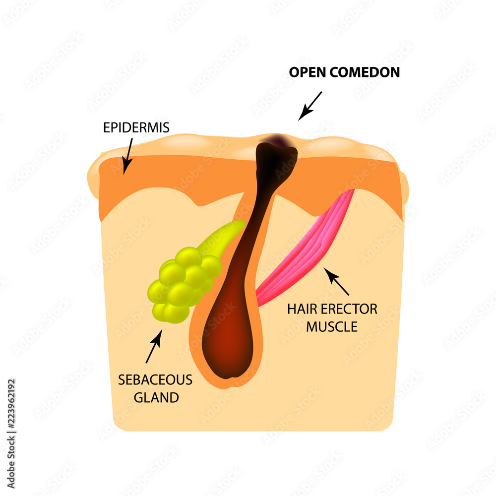 Open comedones. black head acne. The structure of the skin ...