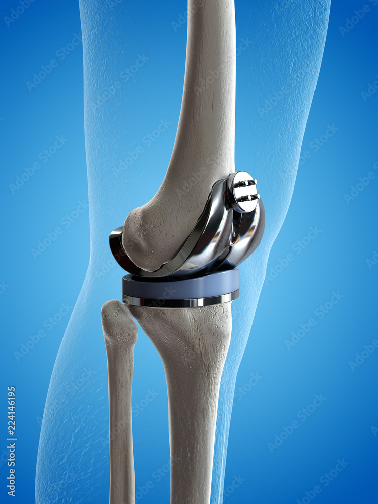 3d rendered medically accurate illustration of a knee replacement Stock ...