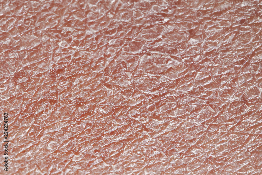 background texture of unhealthy human skin covered with deep wrinkles ...