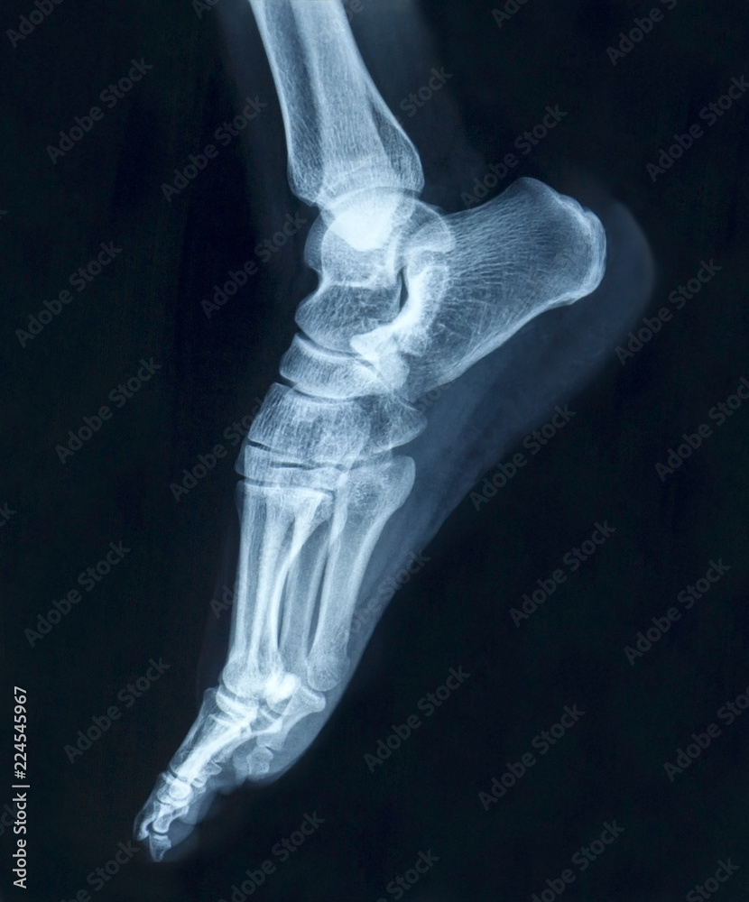 Normal Lateral Foot Xray