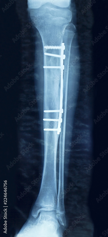 Film x-ray show fracture shaft of tibia and fibular insert plate and ...