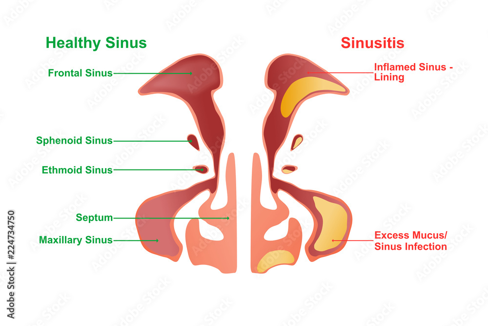 Healthy and inflammation structure respiratory nasal sinus. Study nasal ...