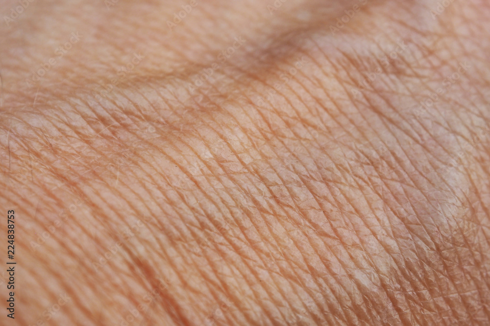 Hand skin with swollen Veins. Human skin and blood vessels in detail ...
