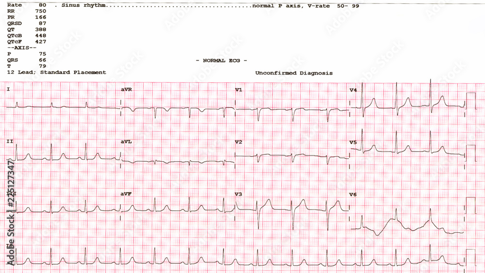 Photo & Art Print cardiogram. waveform from an EKG showing normal EKG ...