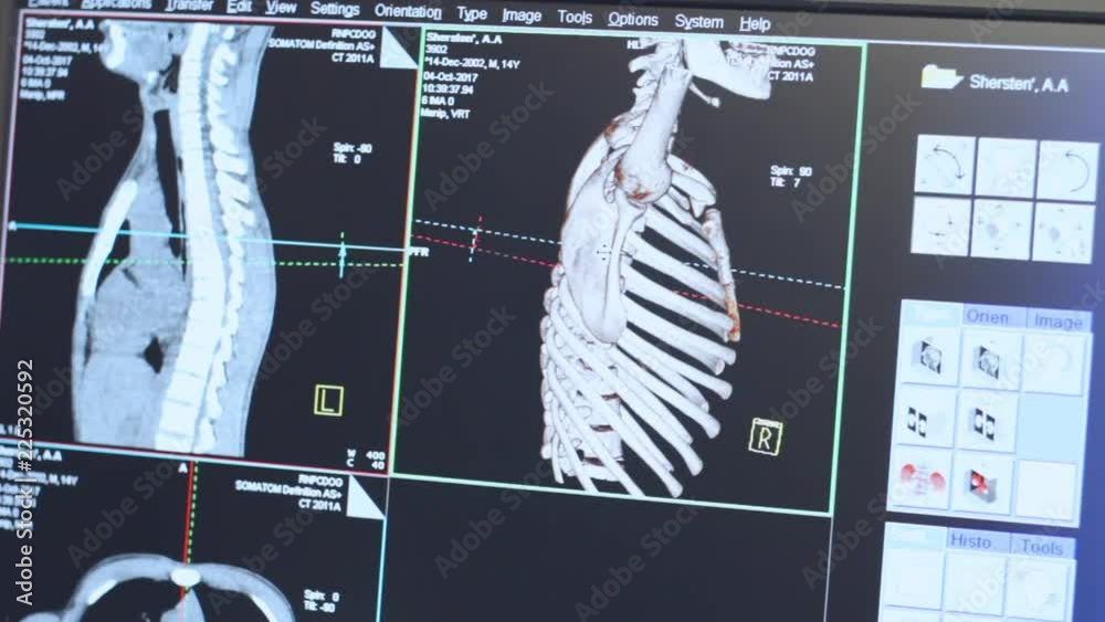 Tomography scan of human rib cage on monitor. High technology ...
